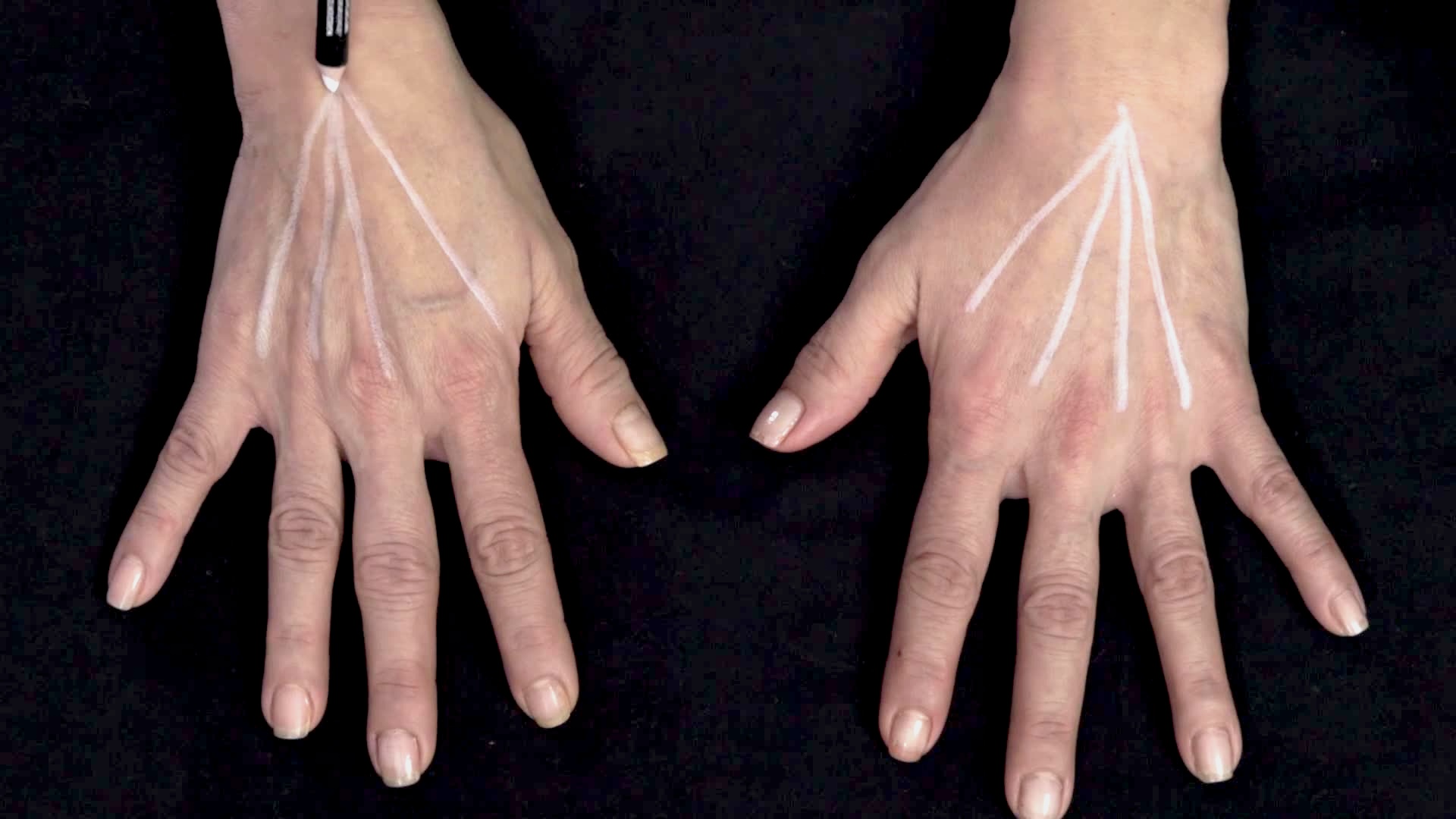 Sculptra for the Hands | Specialty Area | Specialty Area